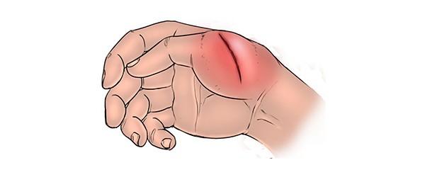 Wound Infection Animation